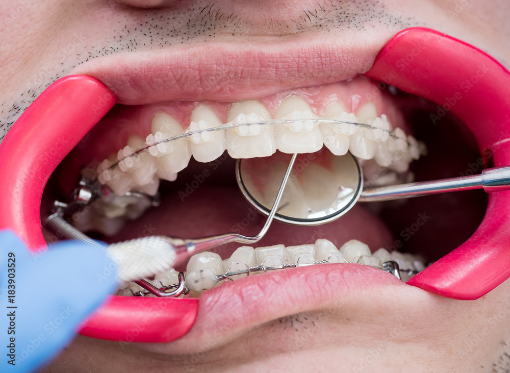 Dentist holding probe and mirror and checking up teeth with brackets at ...