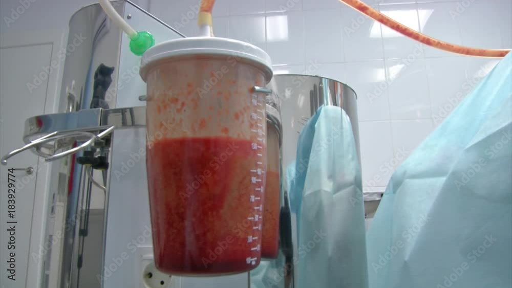 Partial removal of fat and mucous tissues. Fat liquid in the bottle ...