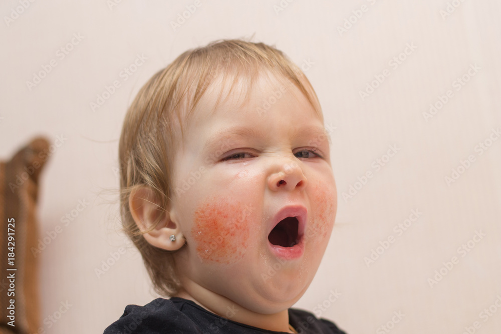 Cute child 1 - 2 years old with eczema or allergic rash on his face ...