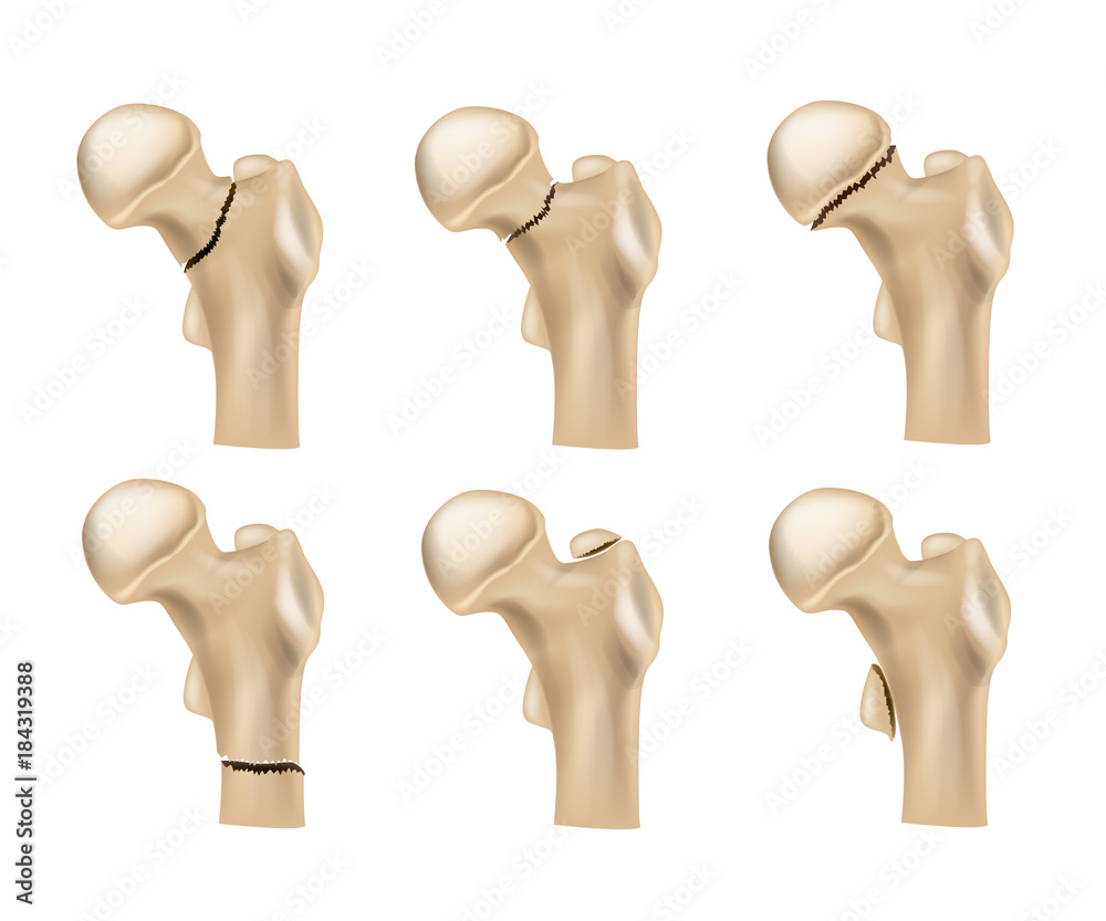 Hip Fractures. Basic fracture types. Stock Vector | Adobe Stock