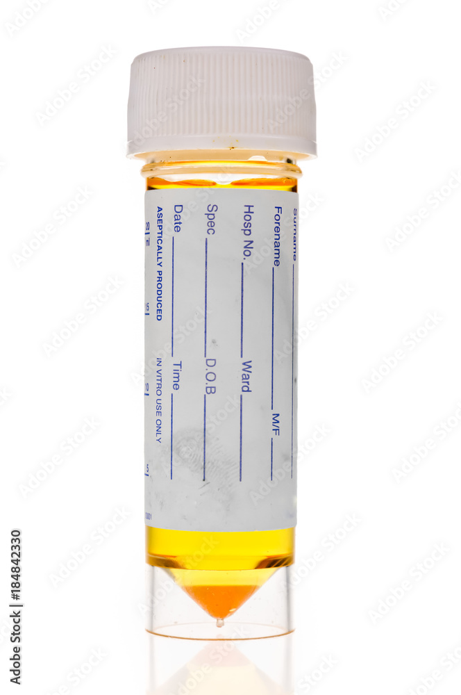 Urine sample in a clear, plastic sample bottle Stock Photo | Adobe Stock