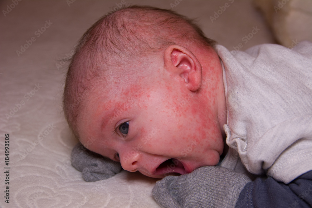 Foto de baby allergy skin food. child dermatitis symptom problem rash ...
