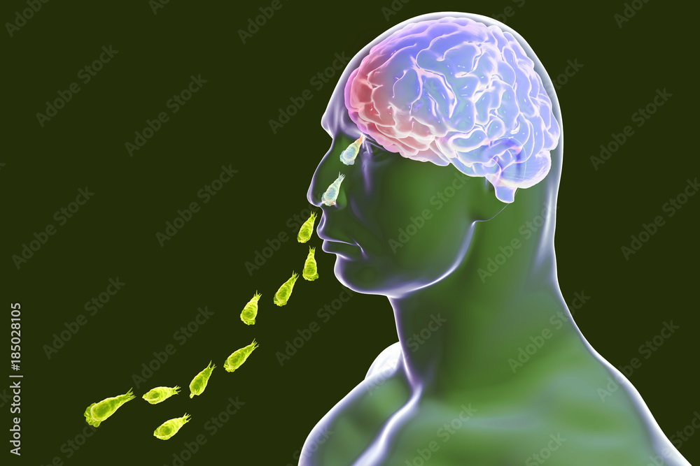 Brain-eating amoeba infection, naegleriasis. Nasal passage of Naegleria ...
