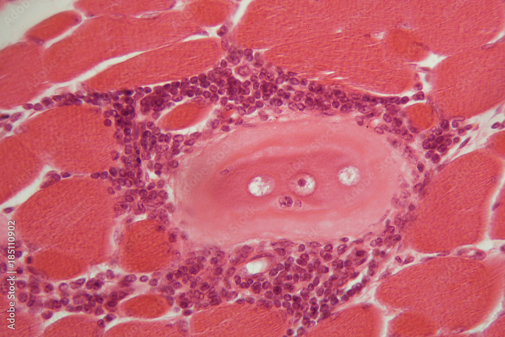 Trichinella spiralis larvae in muscle tissue under the microscope ...