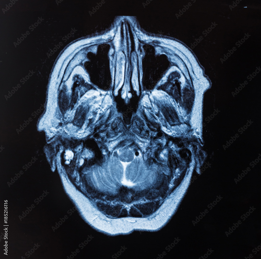 Head MRT. MR image of human brain Stock Photo | Adobe Stock