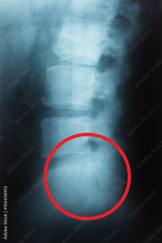 Foto de Film x-ray lumbar spine , L-S spine AP,Lateral view Grade ...