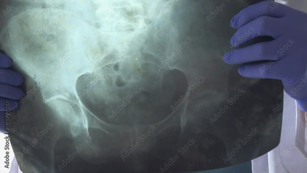 Doctor examining x-ray of the patient's pelvis bone in a medical clinic ...