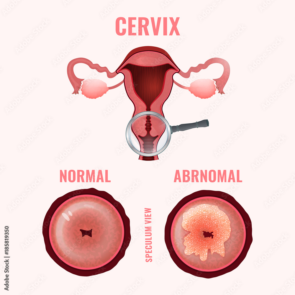 Cervical Cancer Image Vector De Stock Adobe Stock