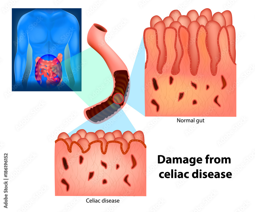 Damage from celiac disease. Celiac disease and Normal gut. Celiac ...