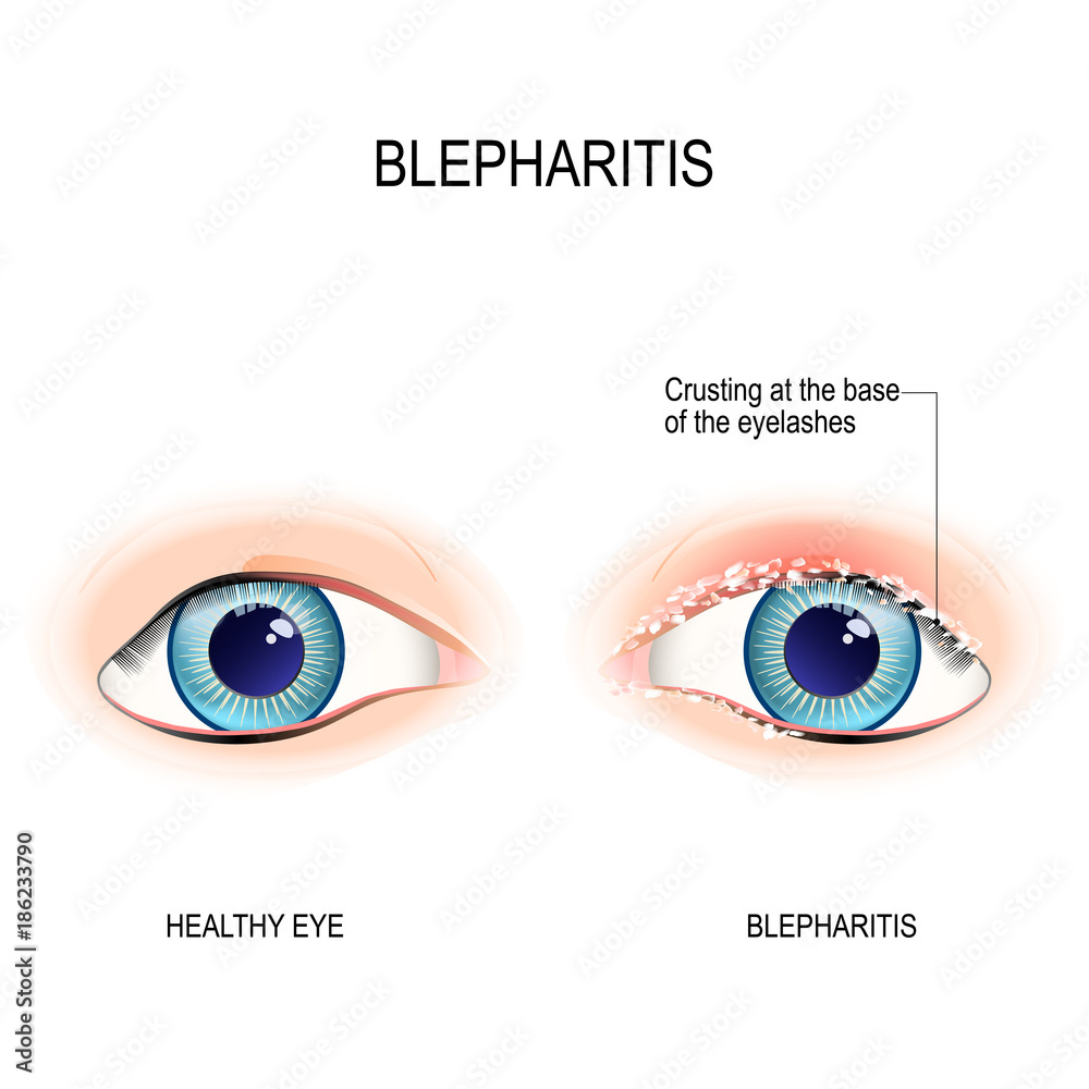 Eyes of human. Blepharitis. Crusting at the eyelid margins Stock Vector ...
