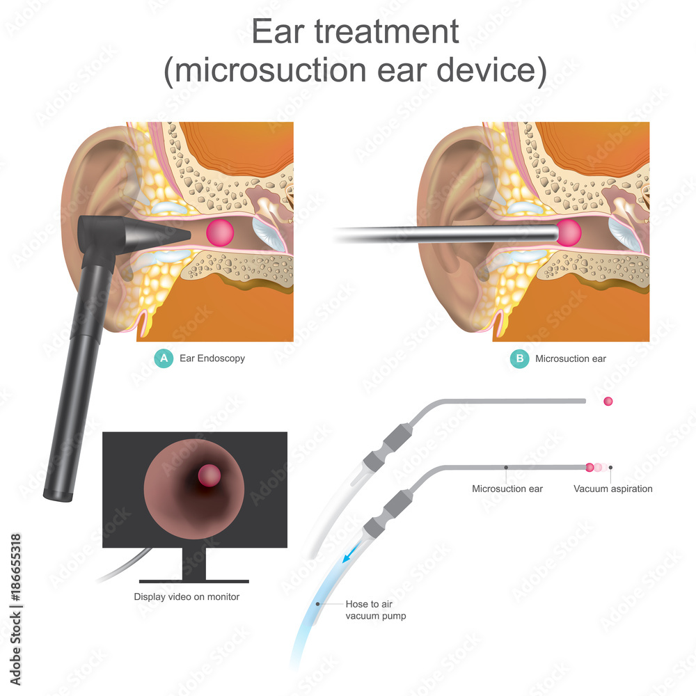 Ball Inside Ear