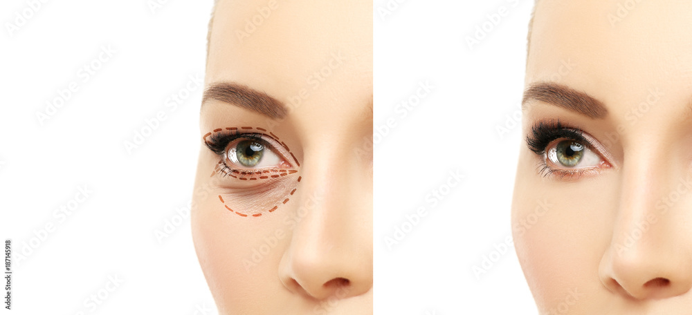 Lower and upper Blepharoplasty.Marking the face.Perforation lines on ...