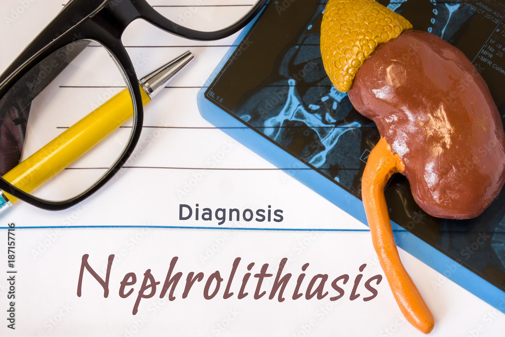 Diagnosis Nephrolithiasis photo. Figure of kidney lies next to ...