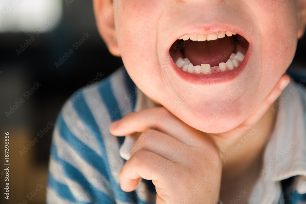 boy showing off his lost tooth Stock Photo | Adobe Stock