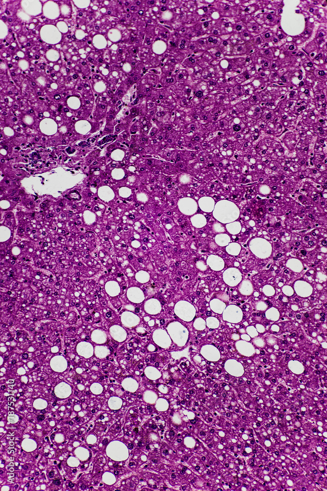 human liver tissue showing fatty degeneration Stock Photo | Adobe Stock