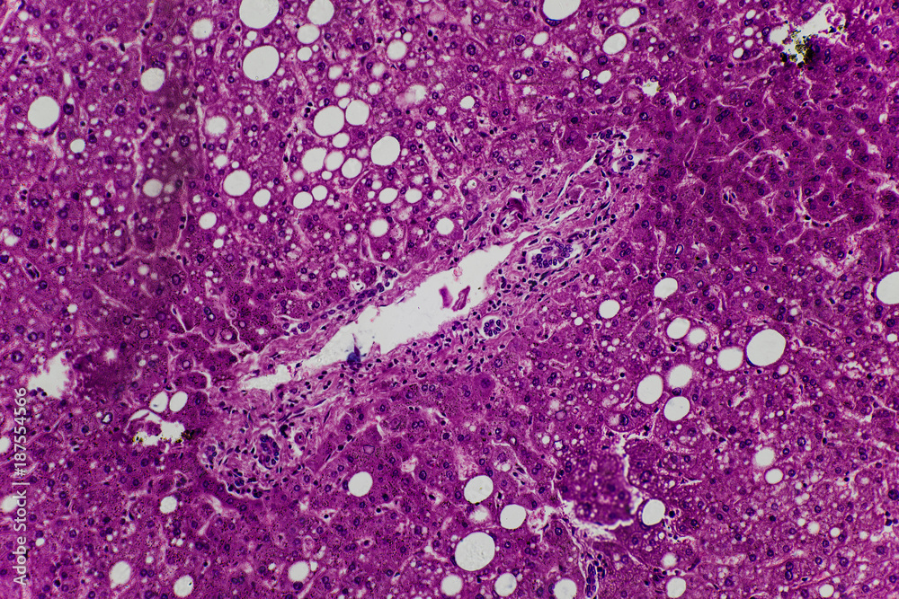 human liver tissue showing fatty degeneration Stock Photo | Adobe Stock