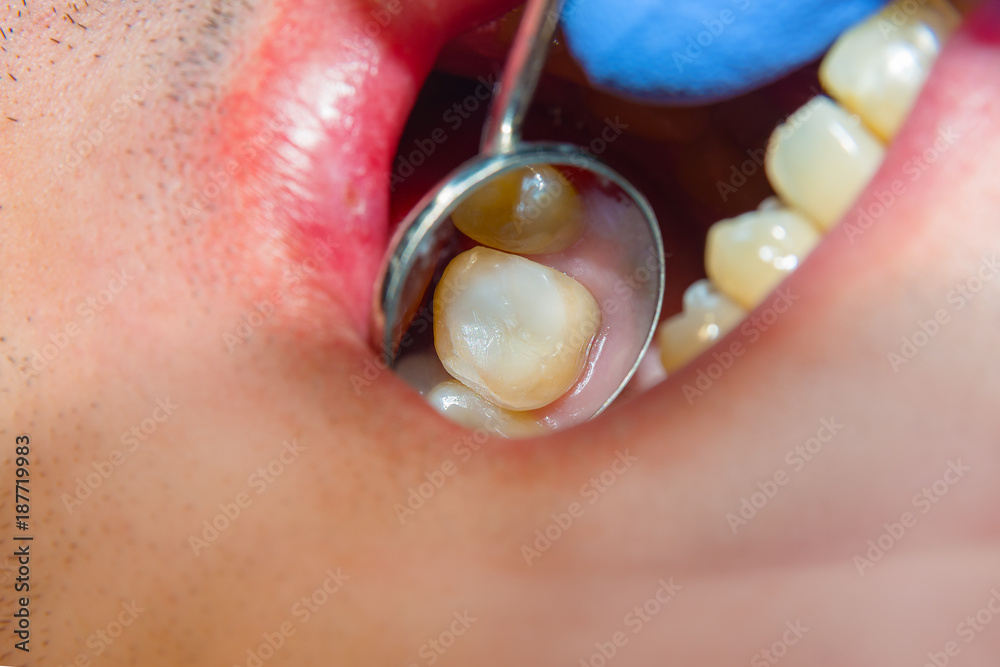 treatment and restoration of rotten carious tooth after root canal ...