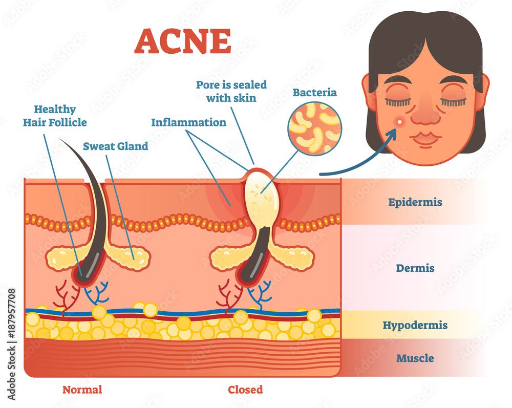 Acne vector diagram illustration with hair, pimple, skin layers and ...