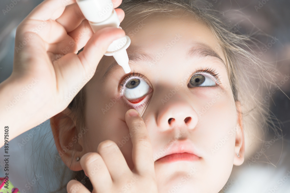 Beautiful girl dripping in eye drops conjunctivitis Stock Photo | Adobe ...
