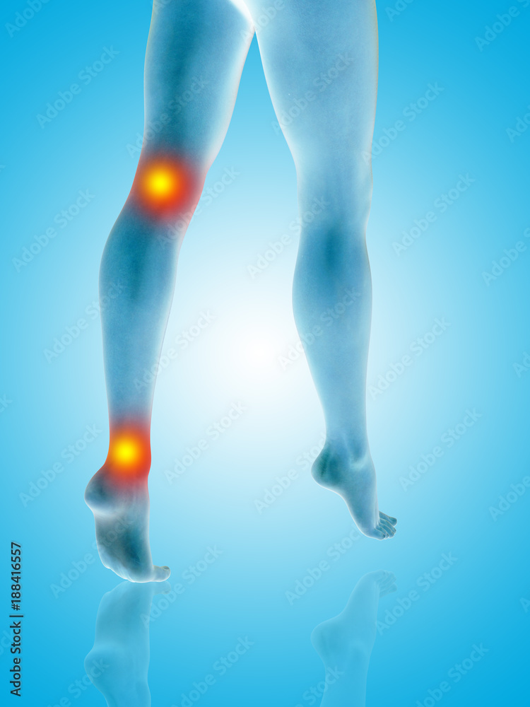Conceptual beautiful woman or girl legs and feet with a hurt knee and ...