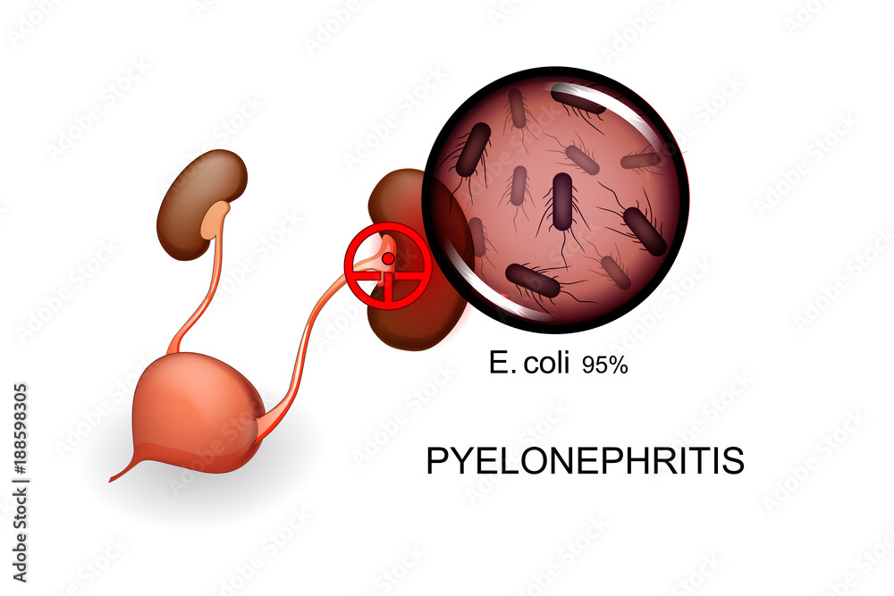 bladder and kidneys. pyelonephritis Stock Vector | Adobe Stock
