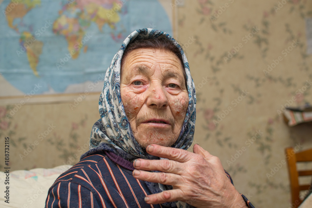 elderly, wrinkled woman with allergies and acne on the face Stock Photo ...