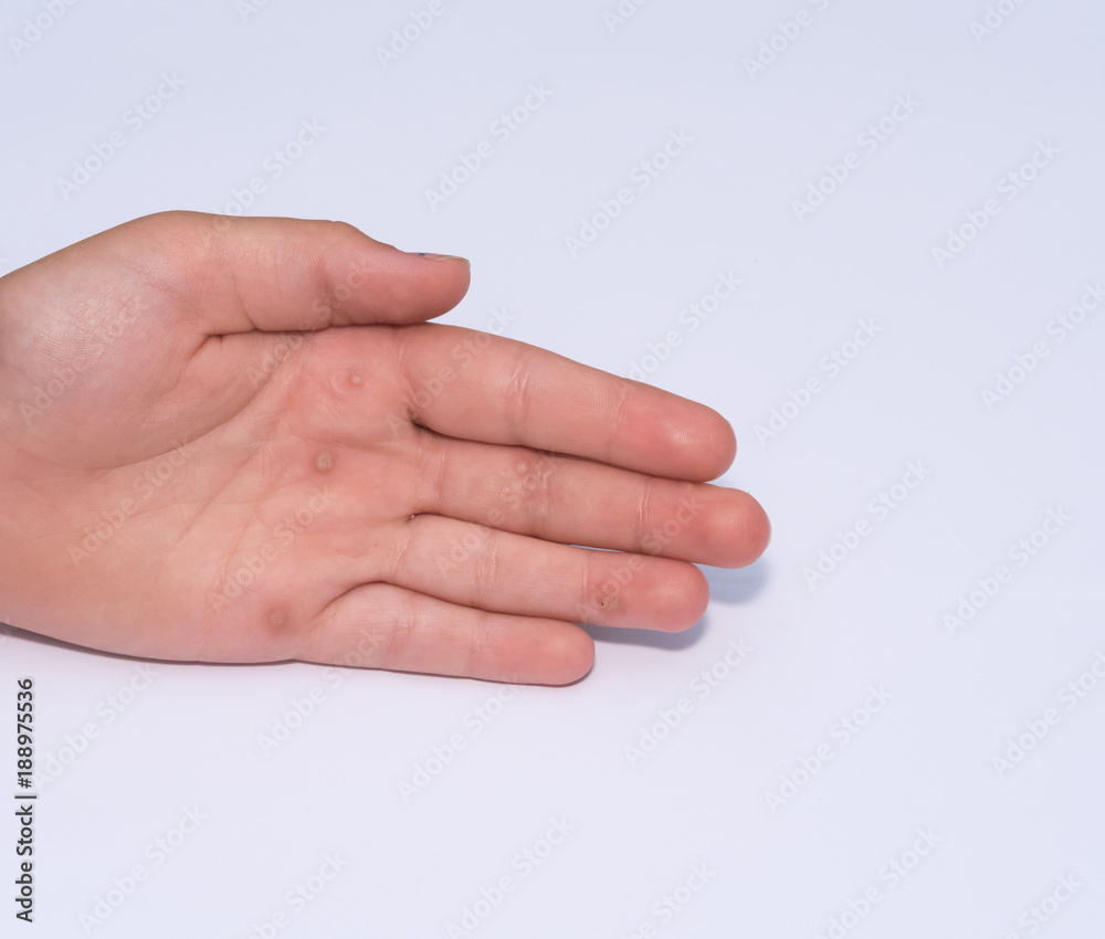 Foto de Common wart Verruca vulgaris also known as HPV do Stock | Adobe ...