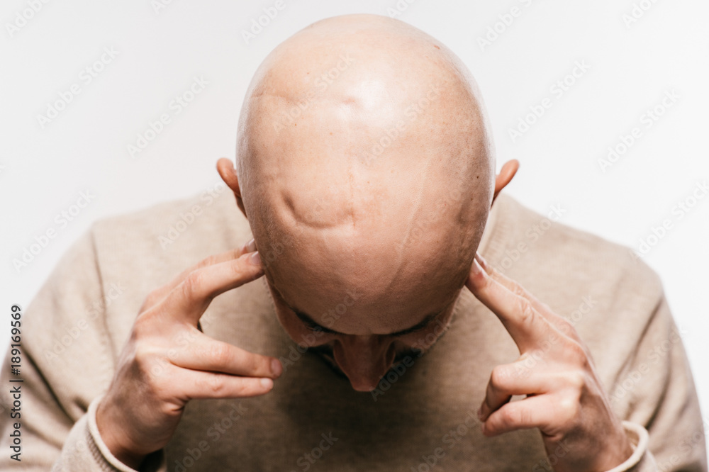 Bald man psychological stress struggling for life arter brain tumor ...