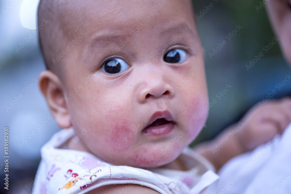 parenting concept, baby atopic dermatitis, rash on face asian baby ...
