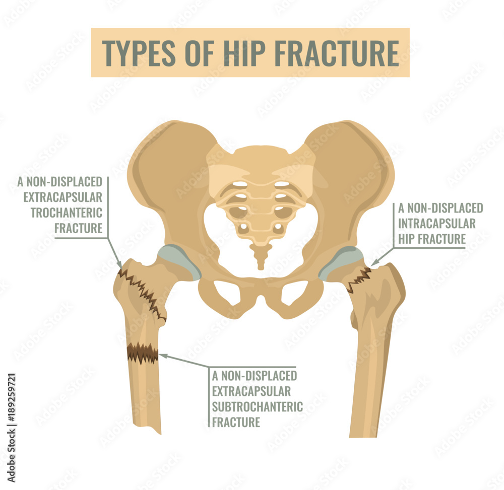 Types of hip fracture Stock Vector | Adobe Stock