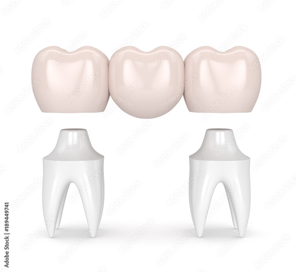 3d render of dental bridge with dental crowns Stock Illustration ...