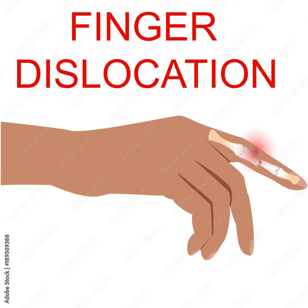 Finger Dislocation human medical organ vector illustratio. Stock Vector ...