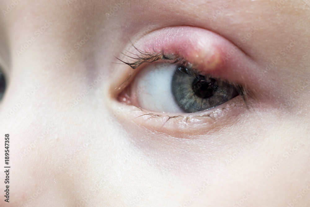 Stye Upper Eyelid