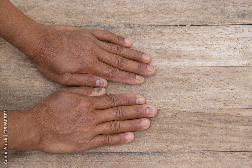 Close up, Old woman's hand shows wrinkles and wounds on wooden ...