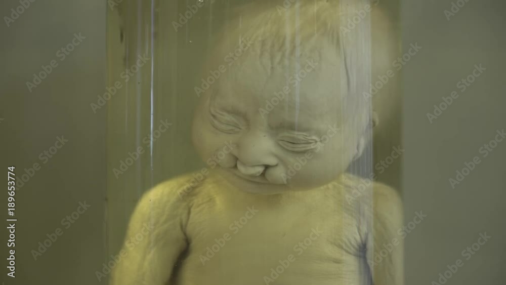 Anatomical preserved human specimens, ugliness, anomalies. Human parts ...