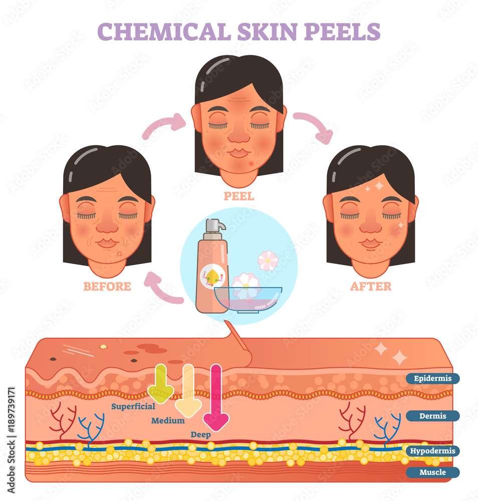 Chemical skin peels vector illustration diagram Stock Vector | Adobe Stock
