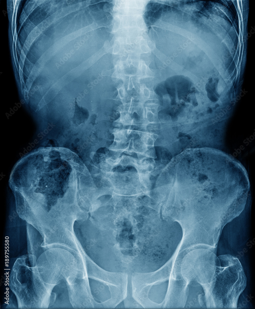 x-ray lower back with pelvic bone show lumbar spondylosis and scoliosis ...