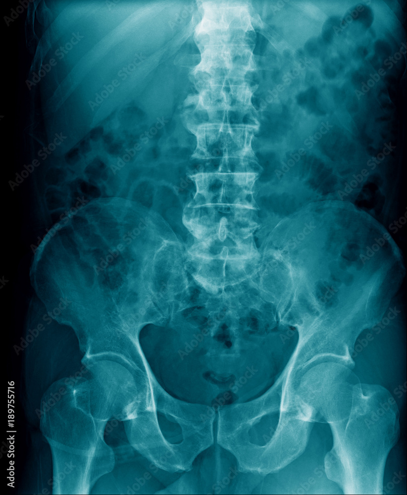 x-ray lower back with pelvic bone show lumbar spondylosis and scoliosis ...