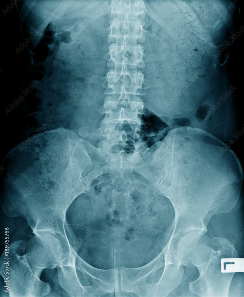 x-ray lower back with pelvic bone show lumbar spondylosis Stock Photo ...