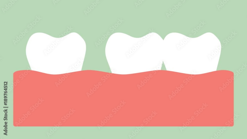 spacing teeth ( diastema ), space between tooth in mouth - dental ...