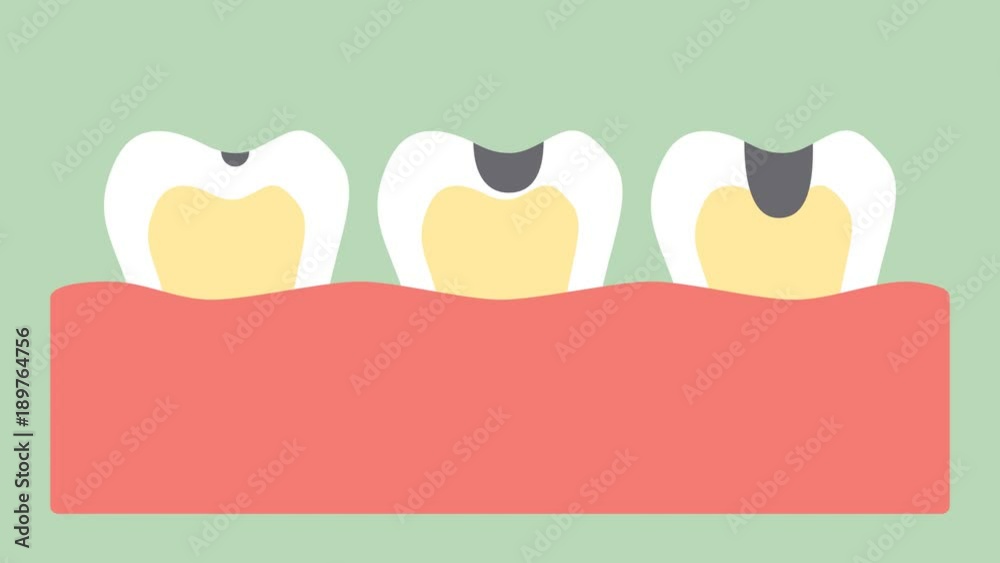 stages of tooth decay or dental caries - dental cartoon vector flat ...