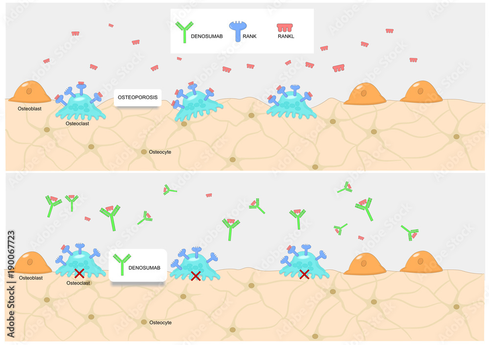 Denosumab, a human monoclonal antibody to treat osteoporosis Stock ...