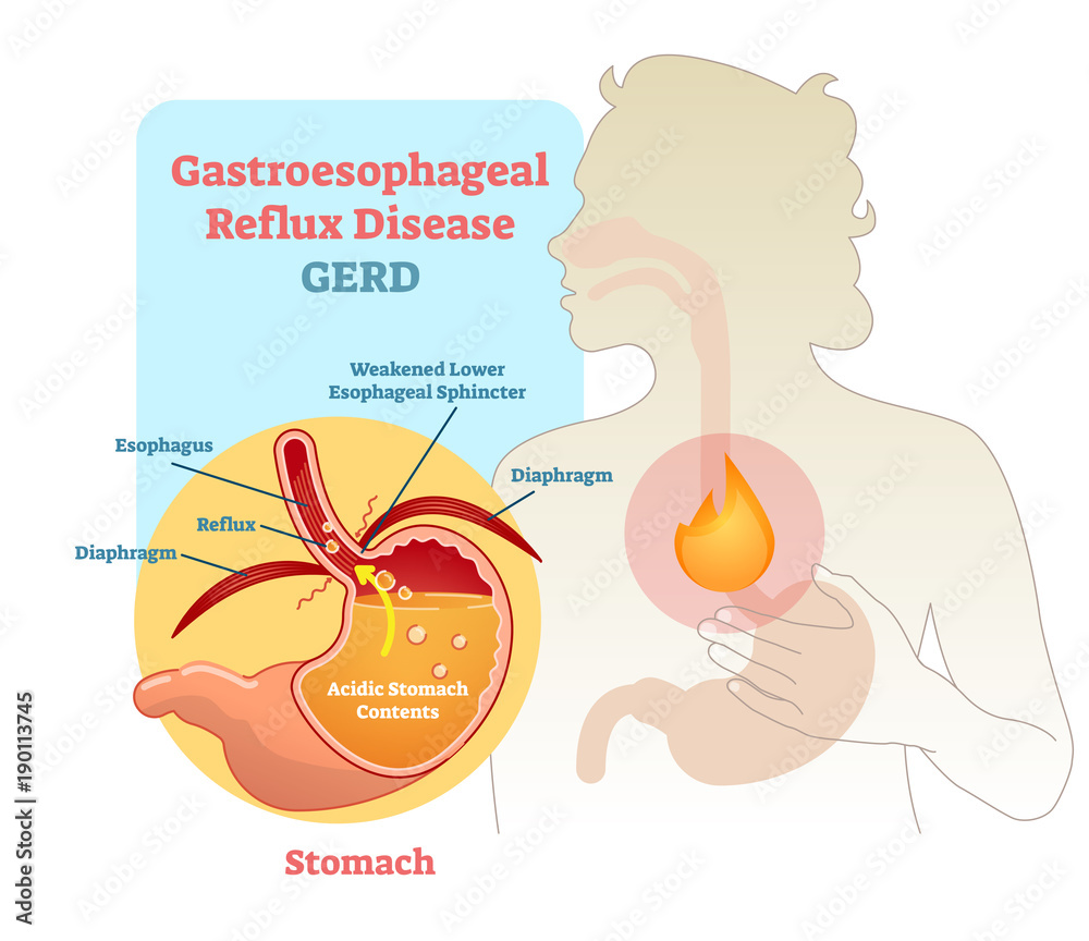 Gastroesophageal Reflux disease diagram scheme Stock Vector | Adobe Stock