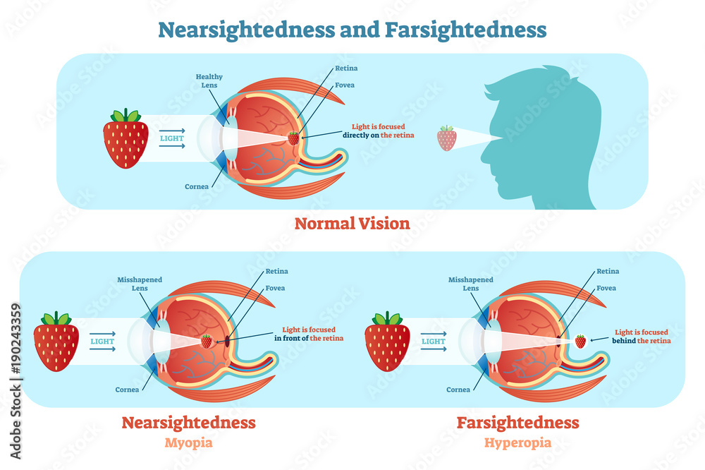 Far Sightedness and Near Sightedness vector illustration diagram ...
