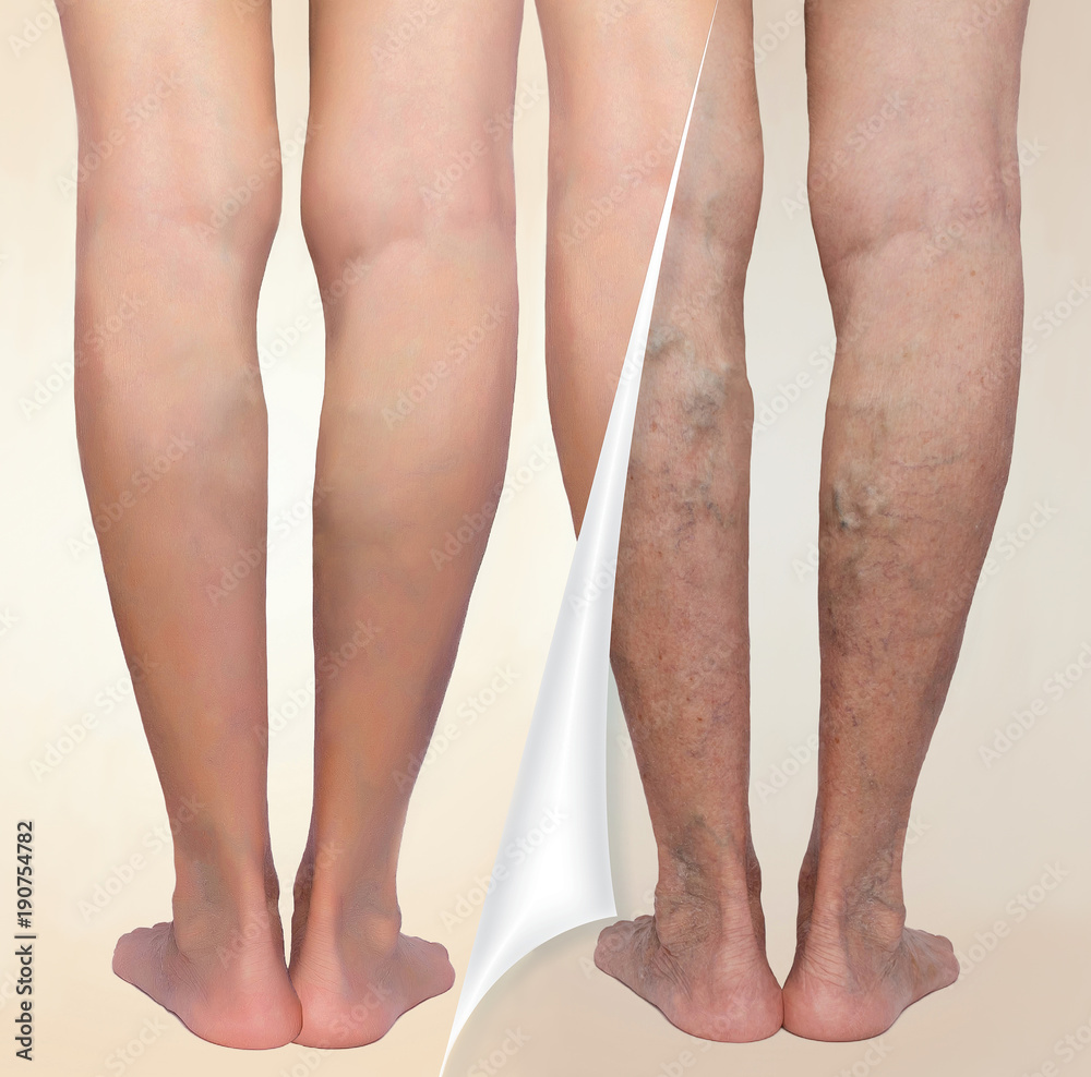Foto de Treatment of varicose before and after. Varicose veins on the ...