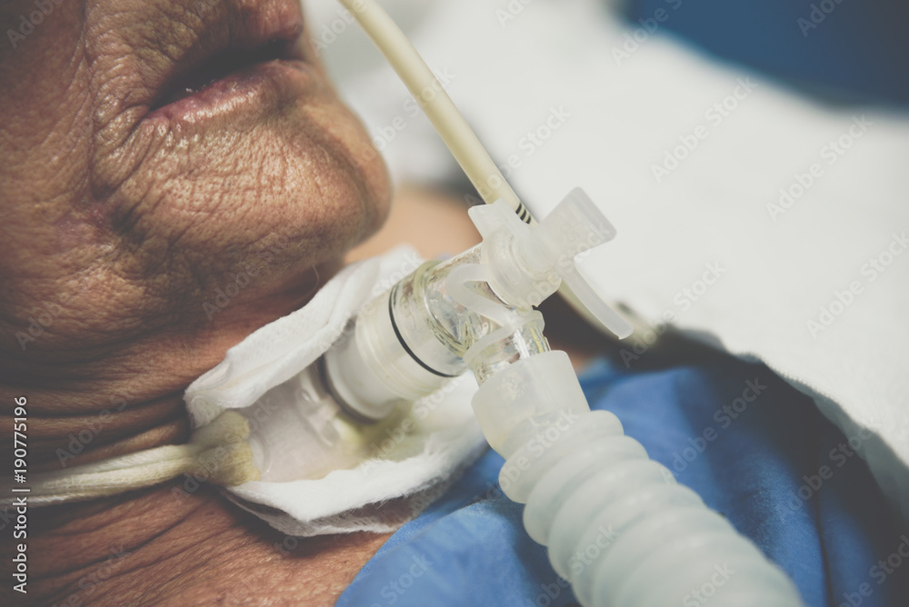 Patient do tracheostomy and ventilator in hospital Stock Photo | Adobe ...