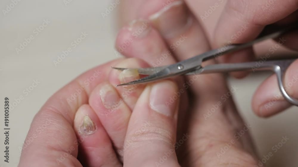 Man cutting toenails with scissors. Male cut toenails on foot. Toenails ...