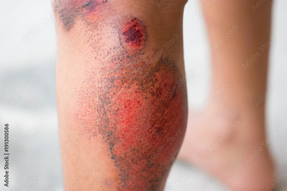 Wounds on the leg, Cause of motorbike accident. Soft focus and blur ...