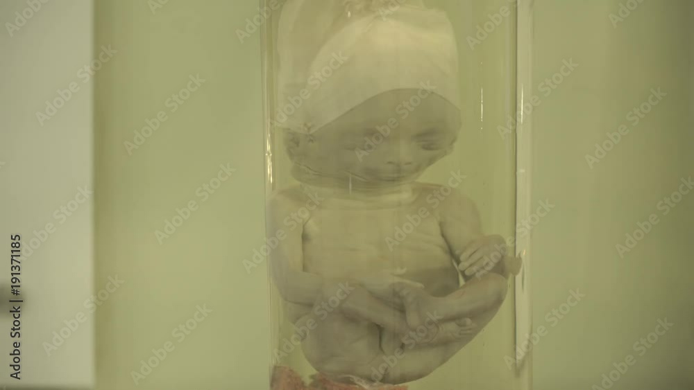 Anatomical preserved human specimens, ugliness, anomalies. Human parts ...