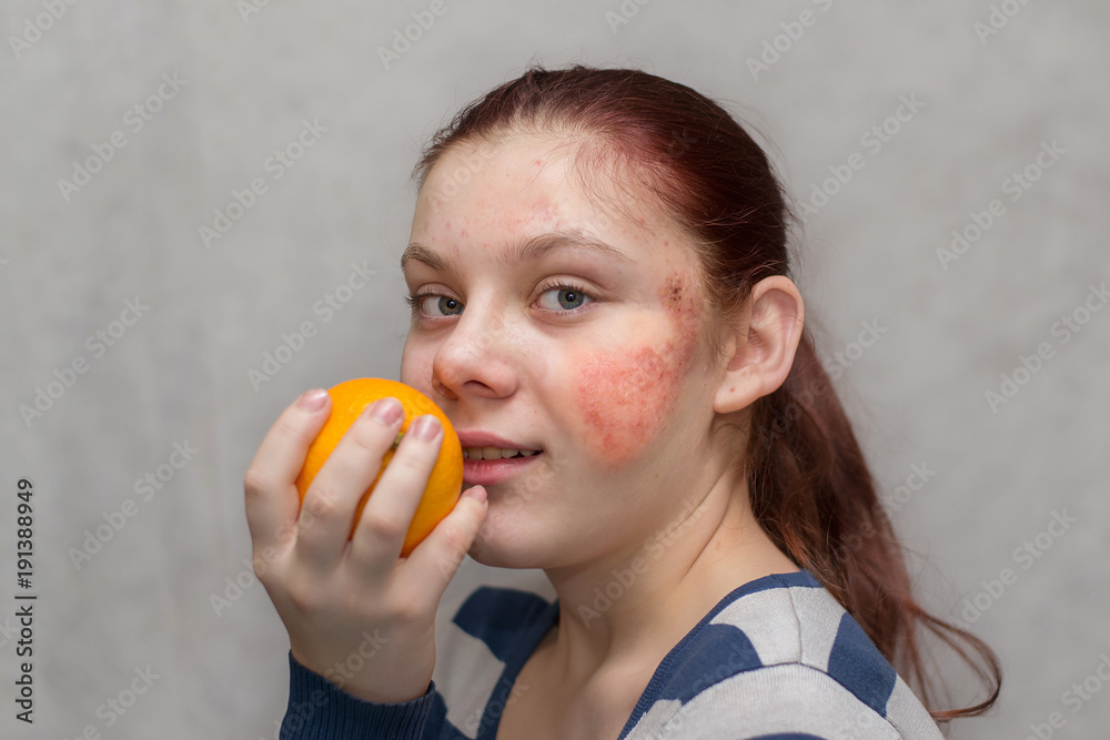 Foto de a young girl with a red rash on her face holds an orange in her ...
